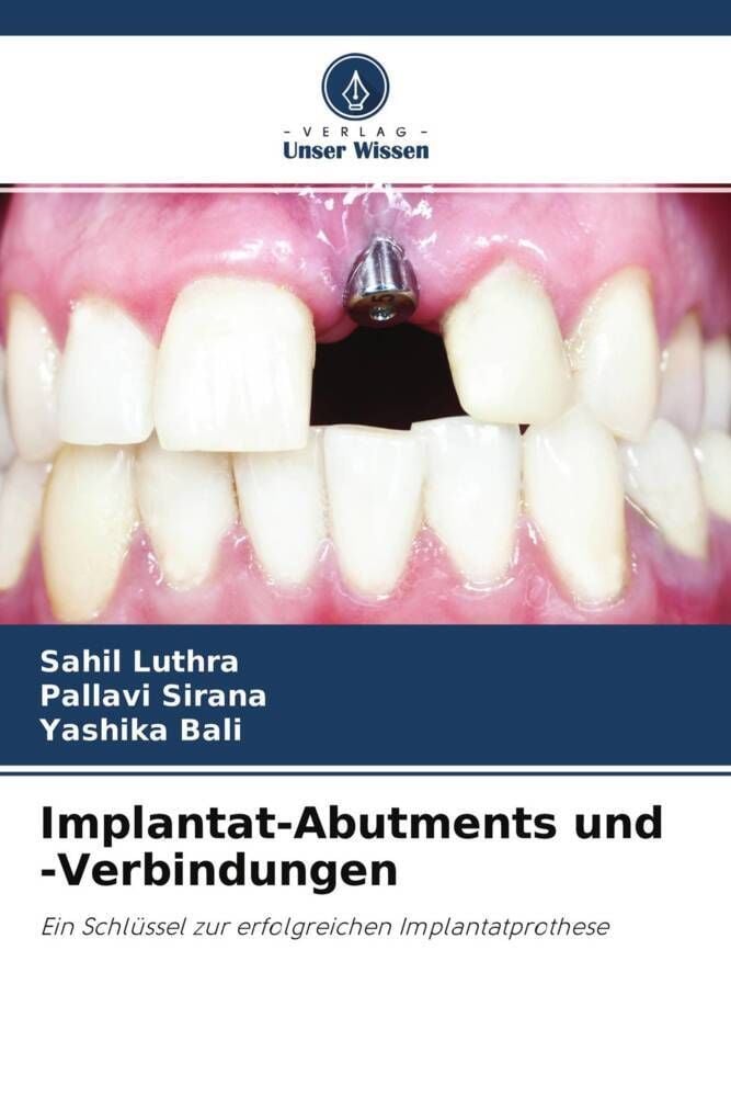 'Implantat-Abutments und -Verbindungen' von 'Sahil Luthra' - Buch ...
